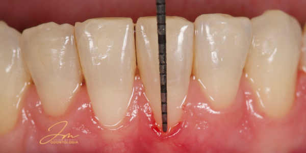 Retração gengival: 1 a cada 3 pessoas tem. Como tratar? - Dra Juliana ...